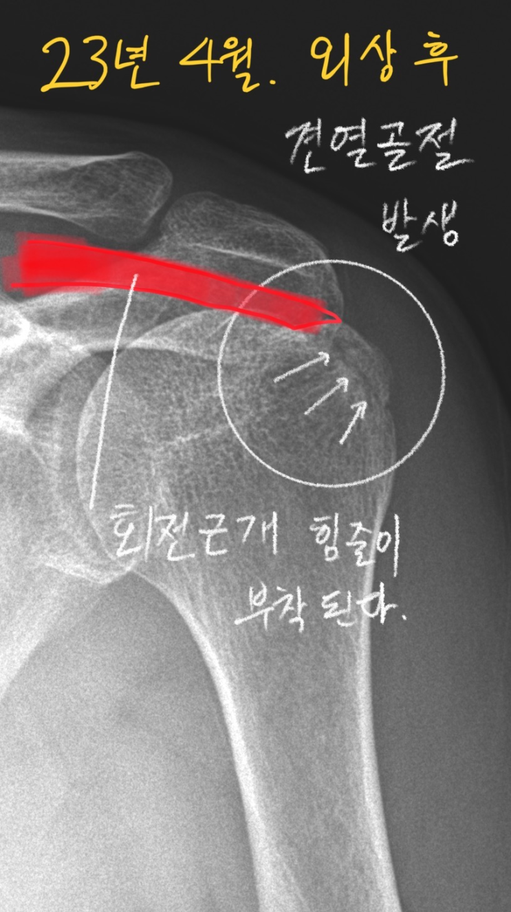 상완골 대결절 견열 골절 진단 및 치료greater Tuberosity Avulsion Fracture 1 네이버 블로그