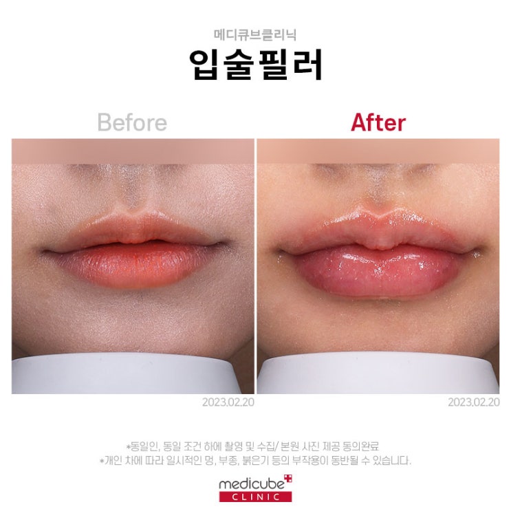 입술필러 총정리주기멍효과입꼬리필러 등 네이버 블로그