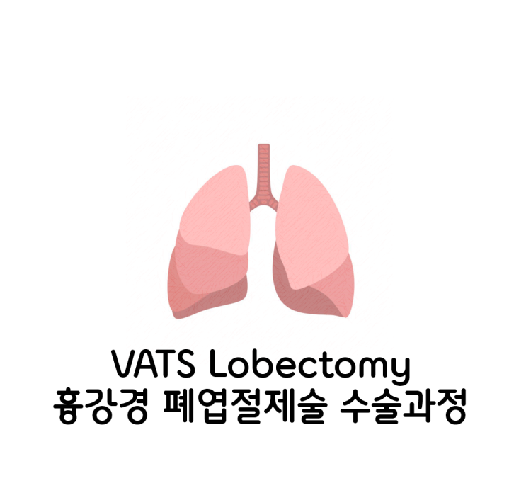 VATS lobectomy LLL (Left lower lobectomy) 수술 과정 : 네이버 블로그