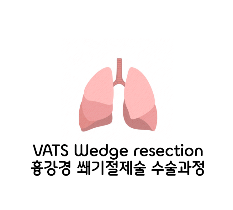 VATS Wedge Resection LLL + explo (흉강경 폐쐐기 절제술) : 네이버 블로그