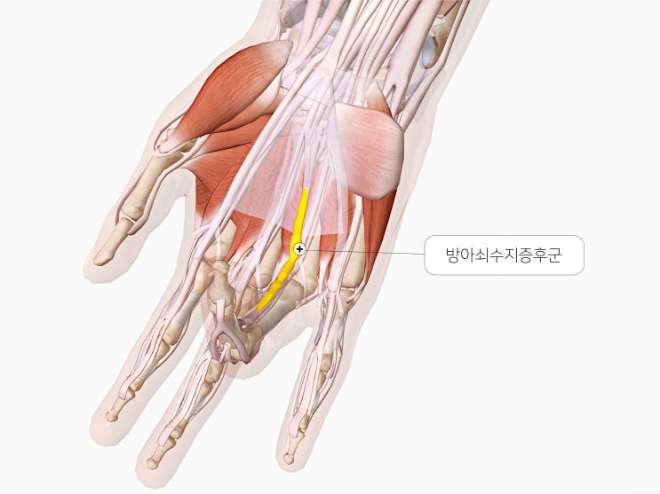손가락 통증 방아쇠수지증후군 증상 의심될때 적절한 치료 방법은 네이버 블로그