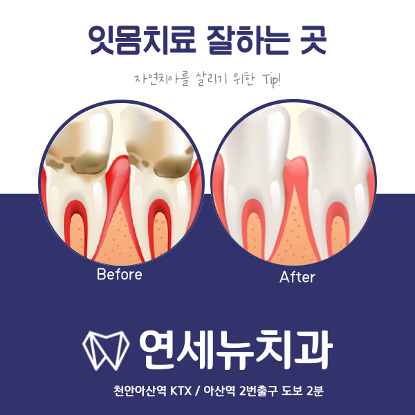 잇몸치료 아프실까봐 걱정이시라구요 잇몸치료 잘하는 천안아산역 연세뉴치과에 방문해보세요 더 늦기 전에 잇몸치료받으시러