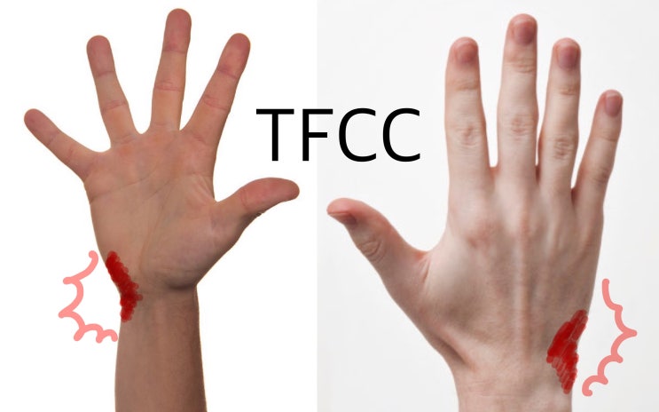 초음파 검사를 통한 TFCC 치료 / 삼각섬유연골복합체 손상 및 치료 / TFCC 비수술치료 : 네이버 블로그
