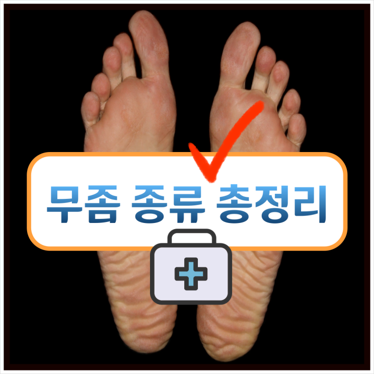 무좀 종류 각화형 수포형 지간형 발무좀 피부 진균증 곰팡이균 완선 백선 발가락 네이버 블로그