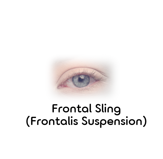 Frontal sling (Frontalis suspension) : 네이버 블로그