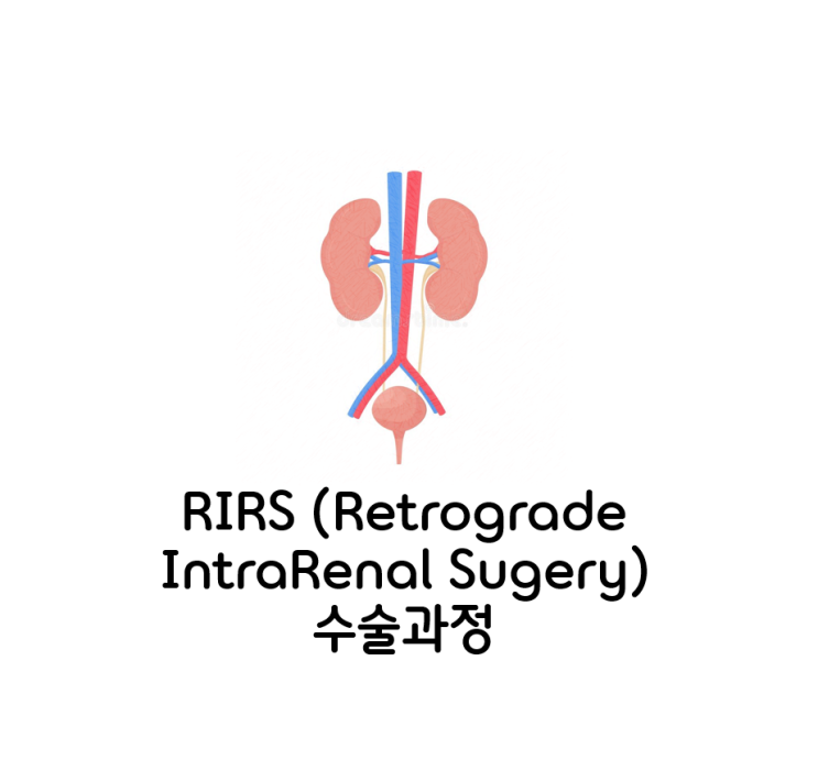 RIRS (Retrograde intrarenal sugery) : 네이버 블로그