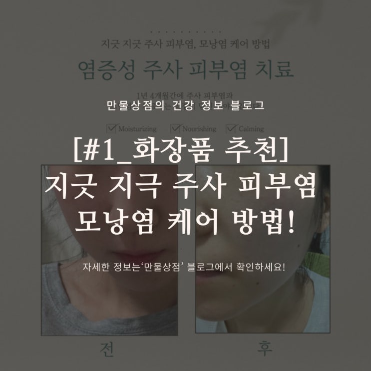 건강 정보•효능 광고 없는😣 극 사실주의 얼굴 주사 피부염 몸 모낭염 박멸 후기 1년 4개월 험난한 치료 과정 주사 피부염