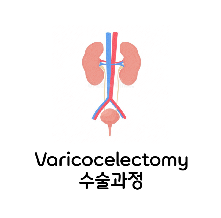 Varicocelectomy (varicocele), 정계정맥류 수술과정 : 네이버 블로그