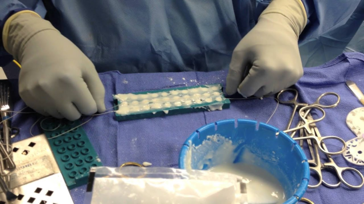 [Infection/감염]Anti cement beads insertion 항생제 시멘트 구슬 삽입 : 네이버 블로그