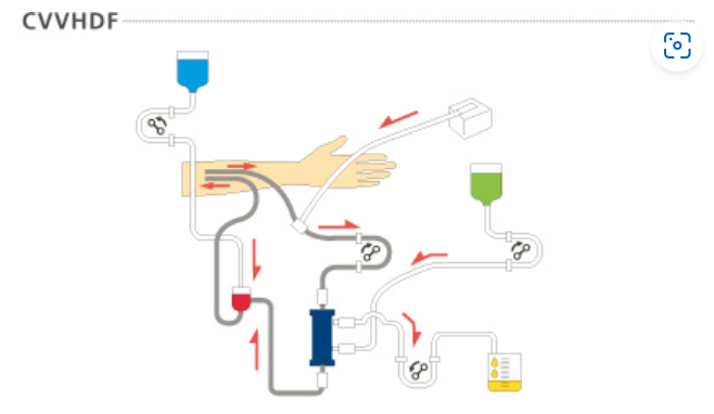 [ CRRT(Continuous Renal Replacement Therapy) chapter 2 l CVVHDF mode ...