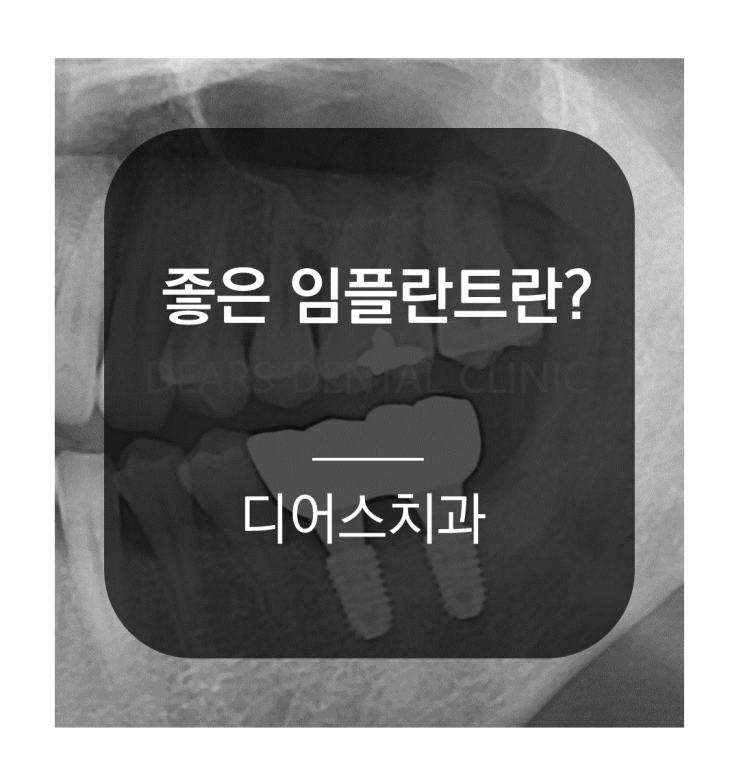 강동구 치과 좋은 임플란트란 Part 1 수술 편 네이버 블로그