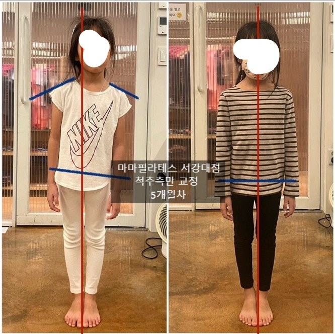 키성장 척추측만증 필라테스 교정운동 네이버 블로그