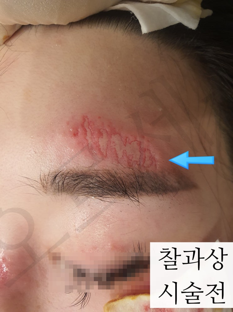 찰과상 재생 콜라겐 흉터 콜라겐 흉터 치료 흉터 레이저 재생 주사 얼굴 흉터 네이버 블로그