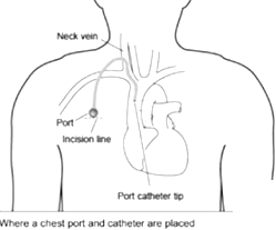 chemo port 1:100 heparization : 네이버 블로그