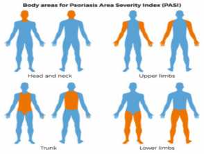 Psoriasis Area and Severity Index (PASI) : 네이버 블로그
