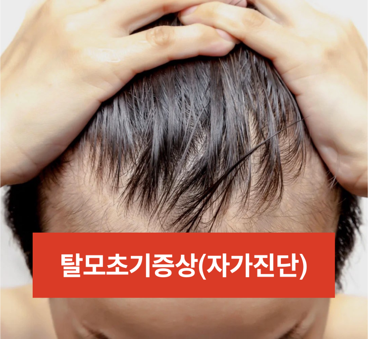 남자 M자 탈모 초기 사진 증상 자가진단 머리 약 병원 샴푸 네이버 블로그