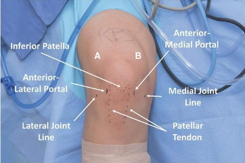 Knee 2-Arthroscopic meniscectomy (연골판 절제 수술) : 네이버 블로그