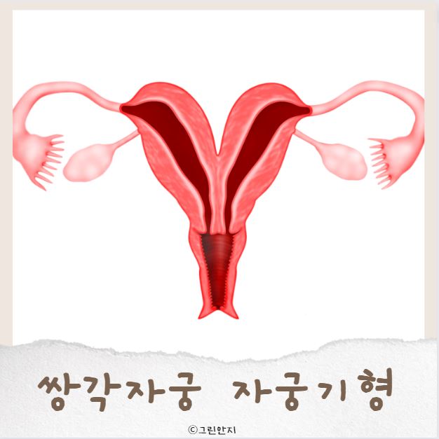 쌍각자궁 임신 중격 선천성 자궁기형 종류와 진단 네이버 블로그