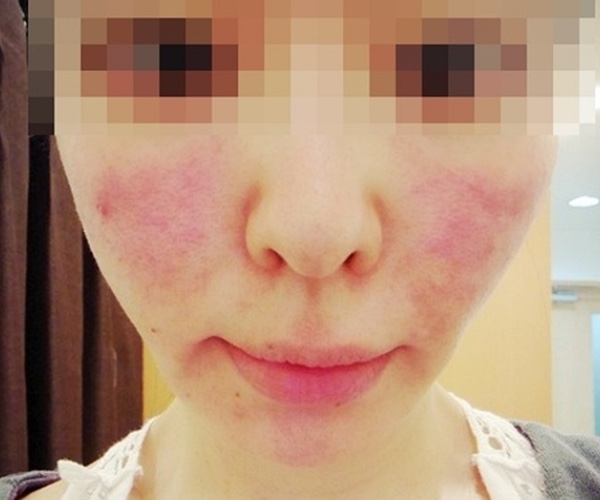 화장품 부작용 조심ㅠ 화장품 피부염 걸렸어요 네이버 블로그