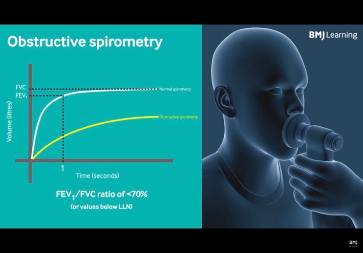 폐기능 검사 PFT (Incentive spirometer) 폐활량 늘리는 법 공부하기 : 네이버 블로그