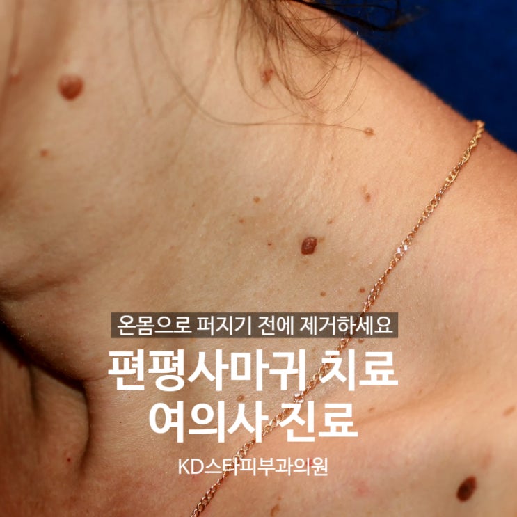 고덕 여의사 피부과얼굴 목 가슴 편평사마귀 제거해야 하는 이유 네이버 블로그