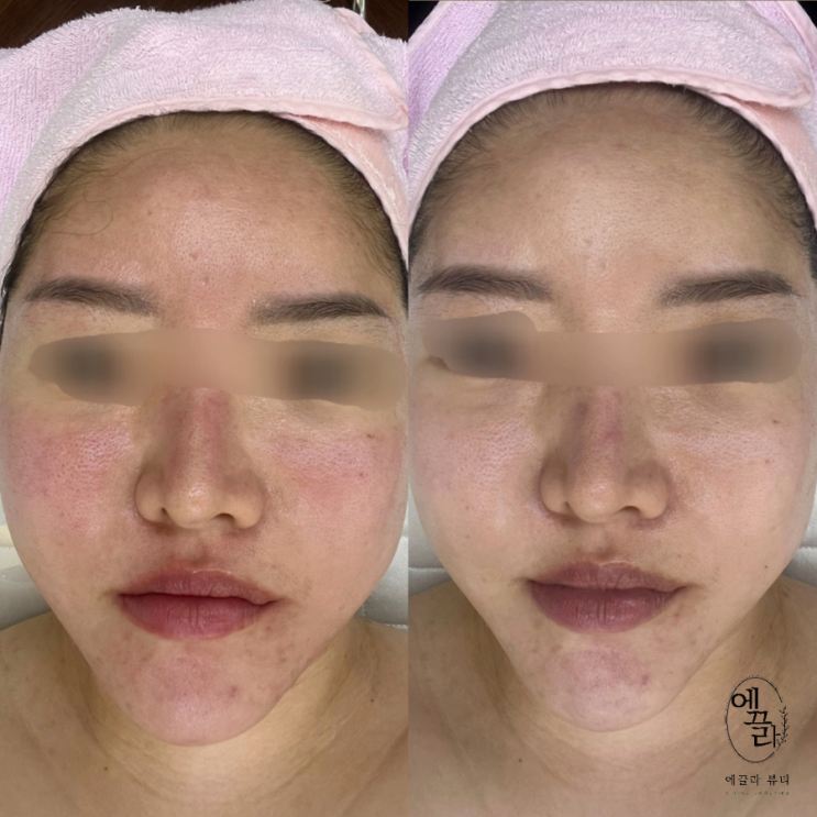 여드름흉터관리모공관리여드름관리재생관리홍조관리에끌라뷰티 네이버 블로그