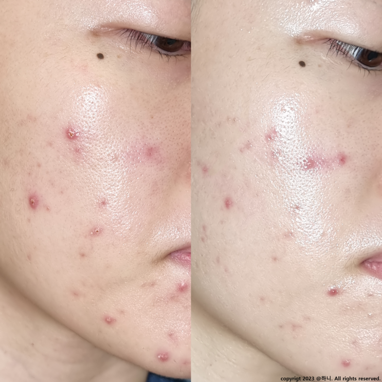 브이빔 실펌 레이저 피부과에서 여드름 얼굴 홍조 치료받은 후기 And 효과 네이버 블로그