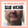 침샘 비대증 침샘 부음 원인 증상 치료 보톡스 귀밑 부음 턱밑 부음 턱밑 살 네이버 블로그