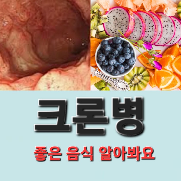 크론병 좋은 음식 알아봐요 : 네이버 블로그