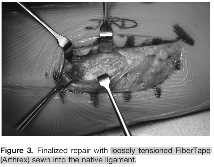 Elbow-팔꿈치/ 내측 척측 인대 봉합술 MUCL repair using internal brace : 네이버 블로그