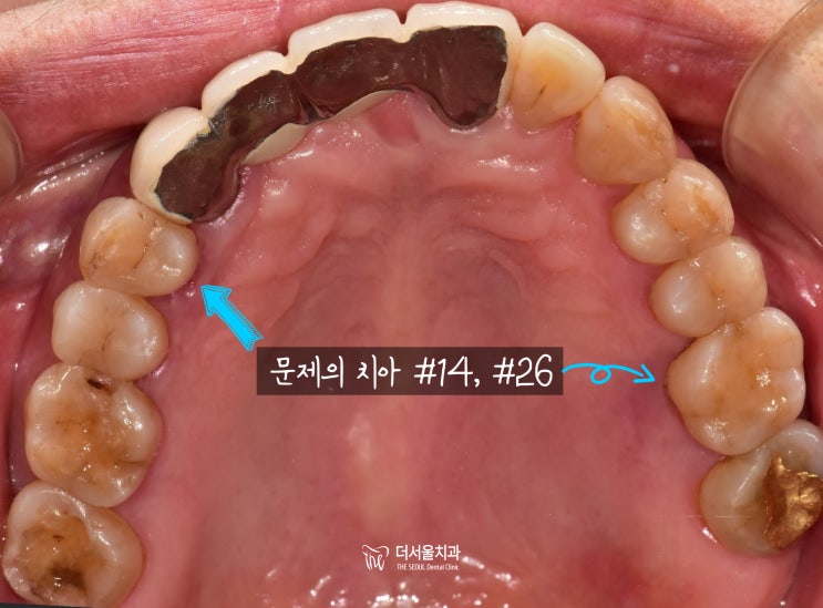 잠실 치과 추천 임플란트 골소실 원인 치주염 및 치아 흔들림 뼈이식 증례 네이버 블로그