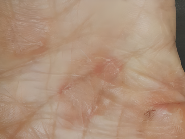 매독 초기증상 치료 기간 비용 및 기타 성병균 네이버 블로그