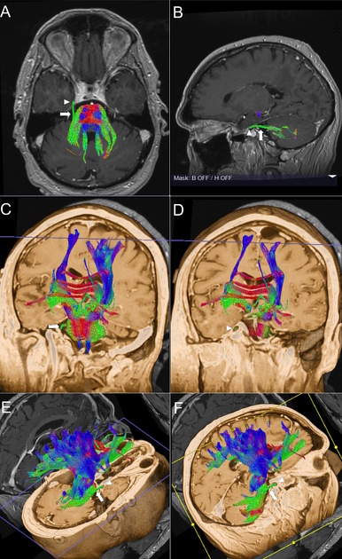 Diffusion Tensor MR Imaging(DTI) : 네이버 블로그
