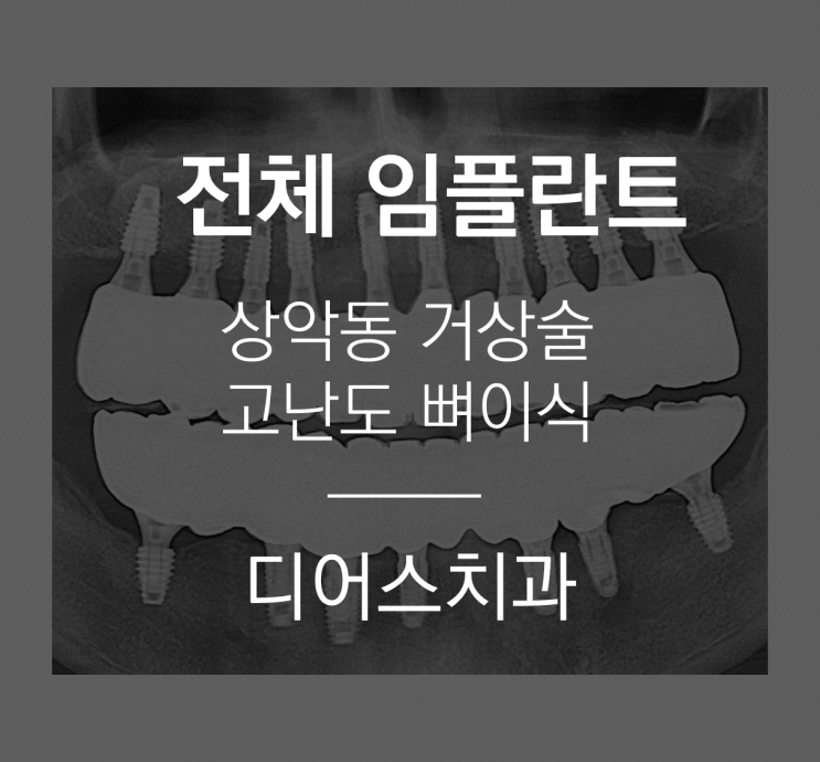 강동 구리 남양주 치과 전체 임플란트 발치 후 즉시 상악동 거상술 및 뼈이식 임플란트 네이버 블로그