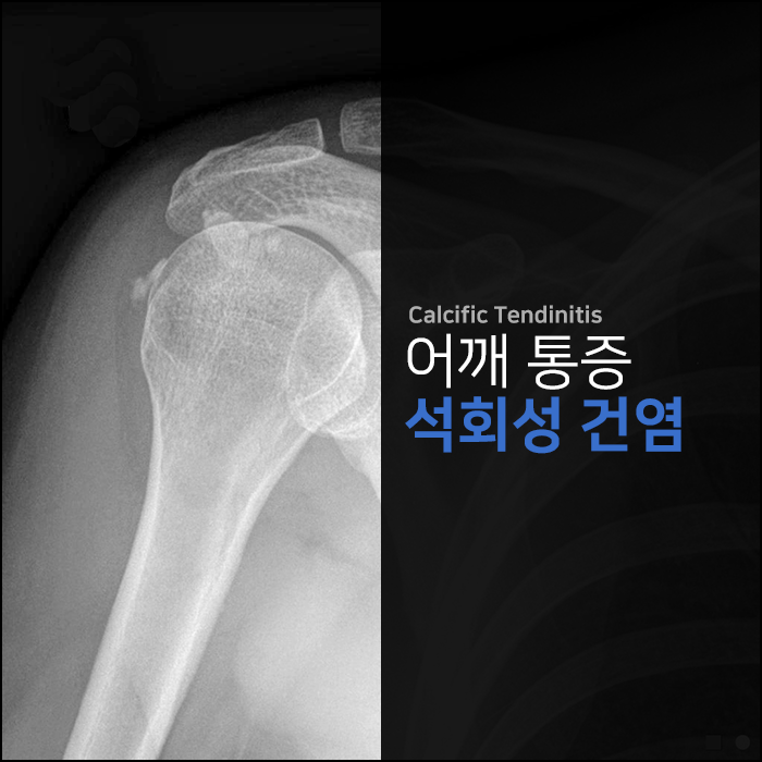석회성 건염 어깨 통증 어깨에 돌 어깨 뚝뚝 소리 서울신정형외과 네이버 블로그