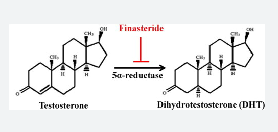 탈모의 이해, 남성호르몬, 테스토스테론, DHT(Dihydrotestosterone), 5알파-환원효소, 모유두 세포 등 ...