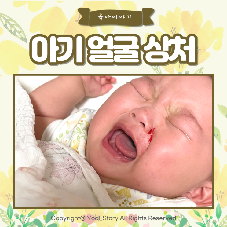 아기 얼굴 상처 피날 때 관리팁 메디폼 에스로반 비판텐 연고 사용 방법 네이버 블로그
