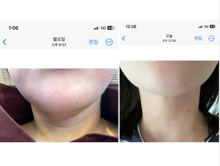 목주름필러 목보톡스로 가로주름해결 목얇아지기 일주일매일사진후기 네이버 블로그