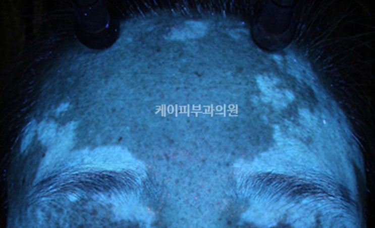 부산백반증 치료얼굴 백반증 엑시머 레이저 치료 효과 네이버 블로그