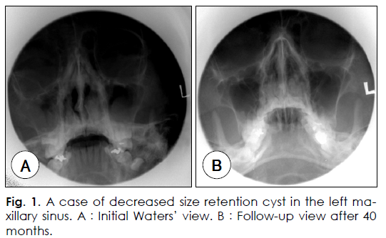 상악동 저류낭종(retention cyst) : 네이버 블로그