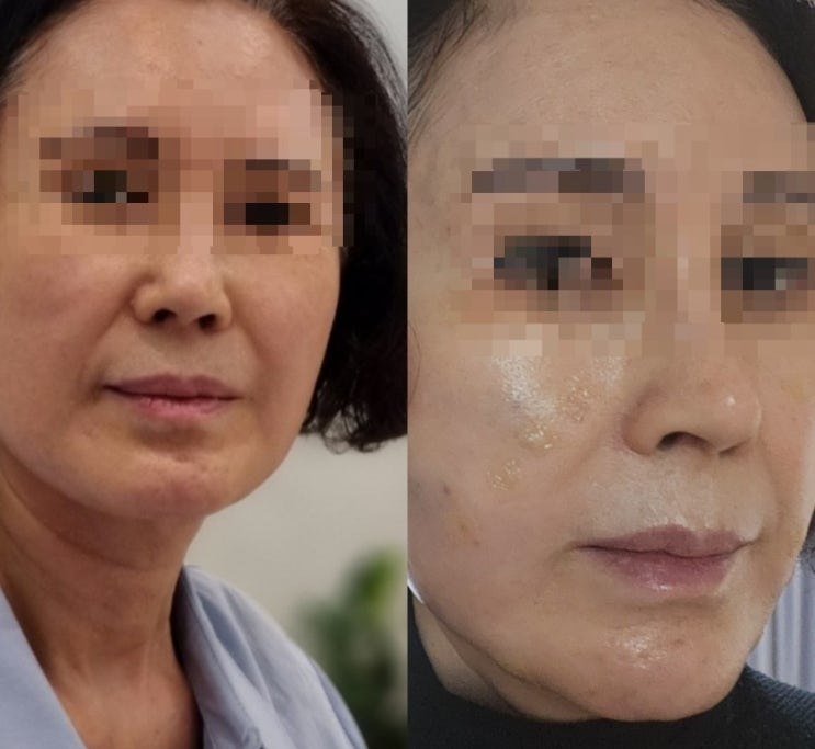 얼굴 민트 실리프팅 팔자주름 없애기 시술 실루엣소프트 통증 부작용 붓기 효과 멍 가격 후기 네이버 블로그