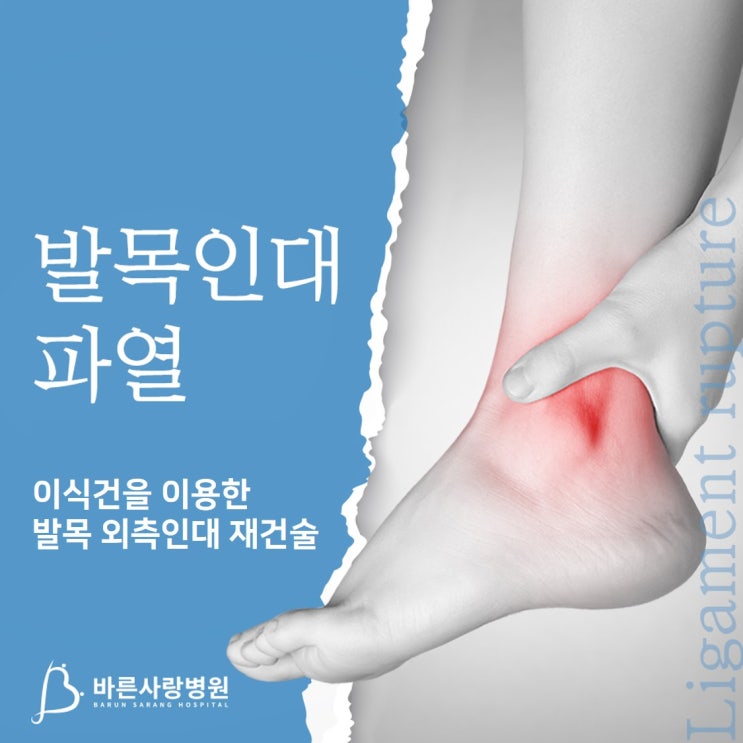 발목인대파열 이식건을 이용한 발목 외측인대 재건술 네이버 블로그