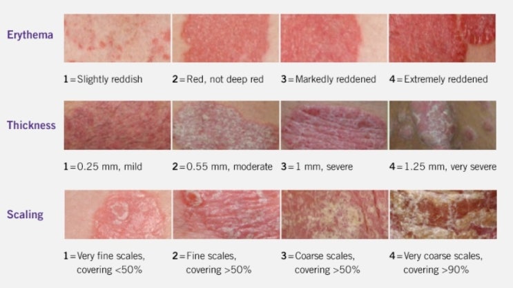 PASI(Psoriasis Area and Severity Index) 평가 법, 건선의 평가법 ㅣ건선 치료 ㅣ광명 한의원 ...