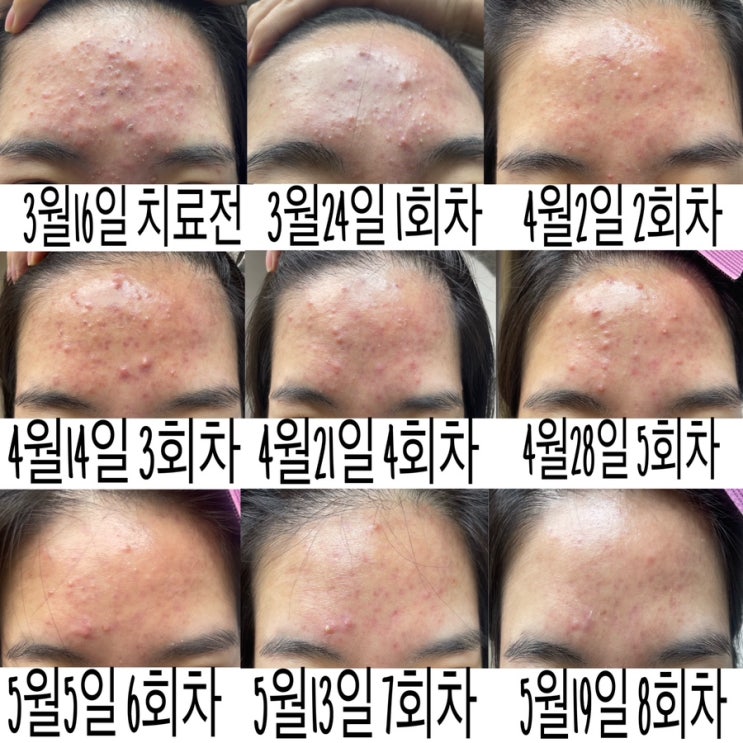 여드름치료5 이소티논 두 달 반 세 달차 지금까지 경과사진 모음집 네이버 블로그