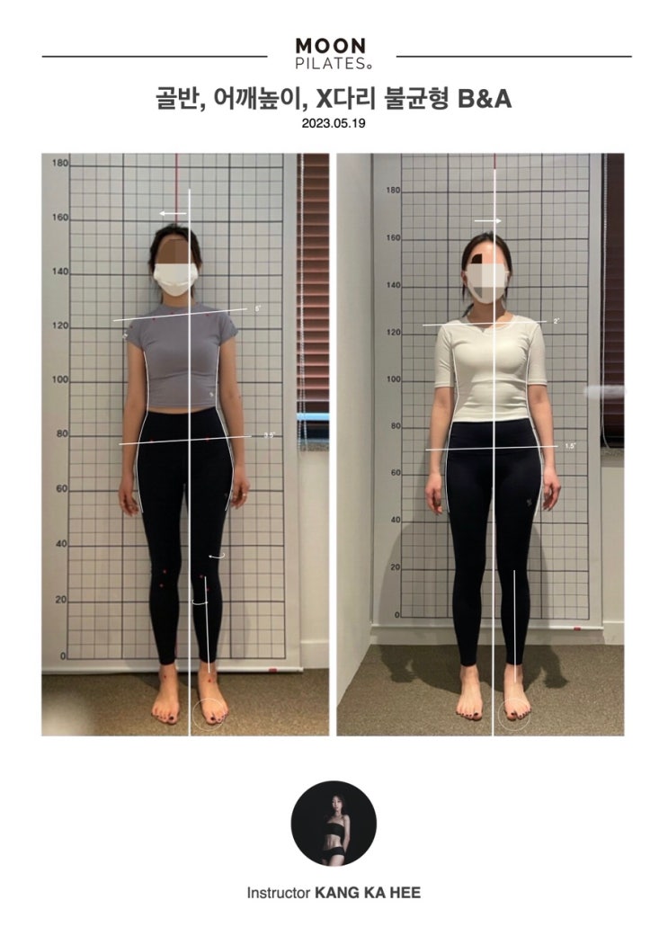 대치동 필라테스 X엑스 다리 무지외반증 골반 불균형 네이버 블로그