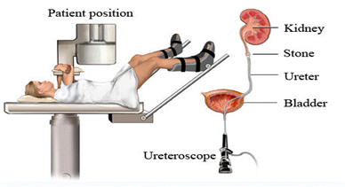 URS(ureteroscopy ureterolithotomy) 요관경 검사 요관결석절제술 : 네이버 블로그
