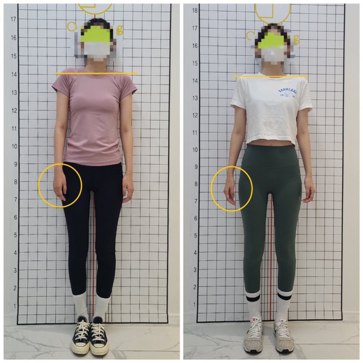 [Before & After] 라운드 숄더(말린 어깨) : 네이버 블로그