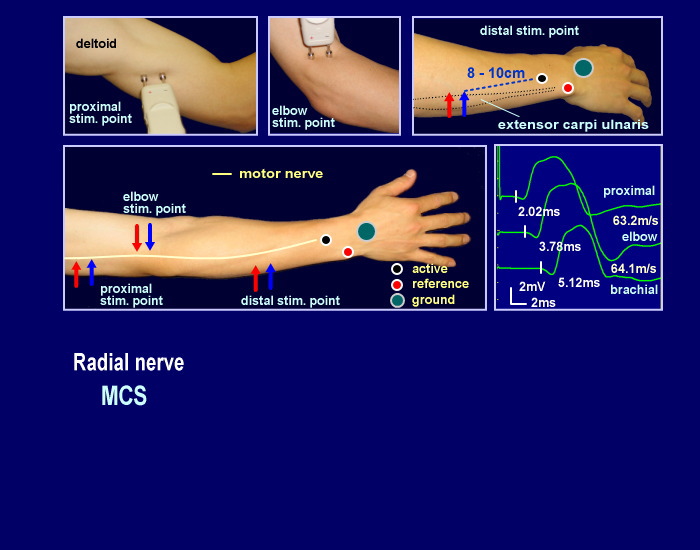 요골신경 (Radial Nerve) : 네이버 블로그