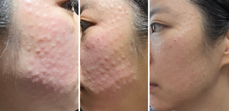 리쥬란 HB 2cc 솔직후기 - 2주 경과 : 네이버 블로그