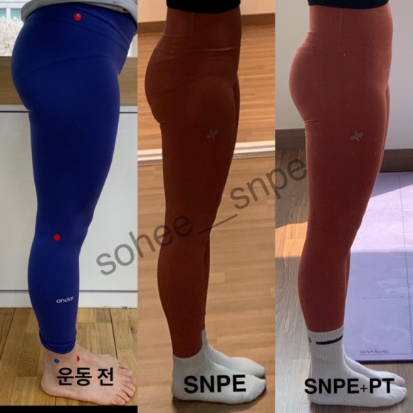 [부산snpe]24년 동안 유전이라고 생각한 하체비만, 휜 다리 100% SNPE를 통해 하체비만 휜 다리 탈출하는 방법 : 네이버 블로그